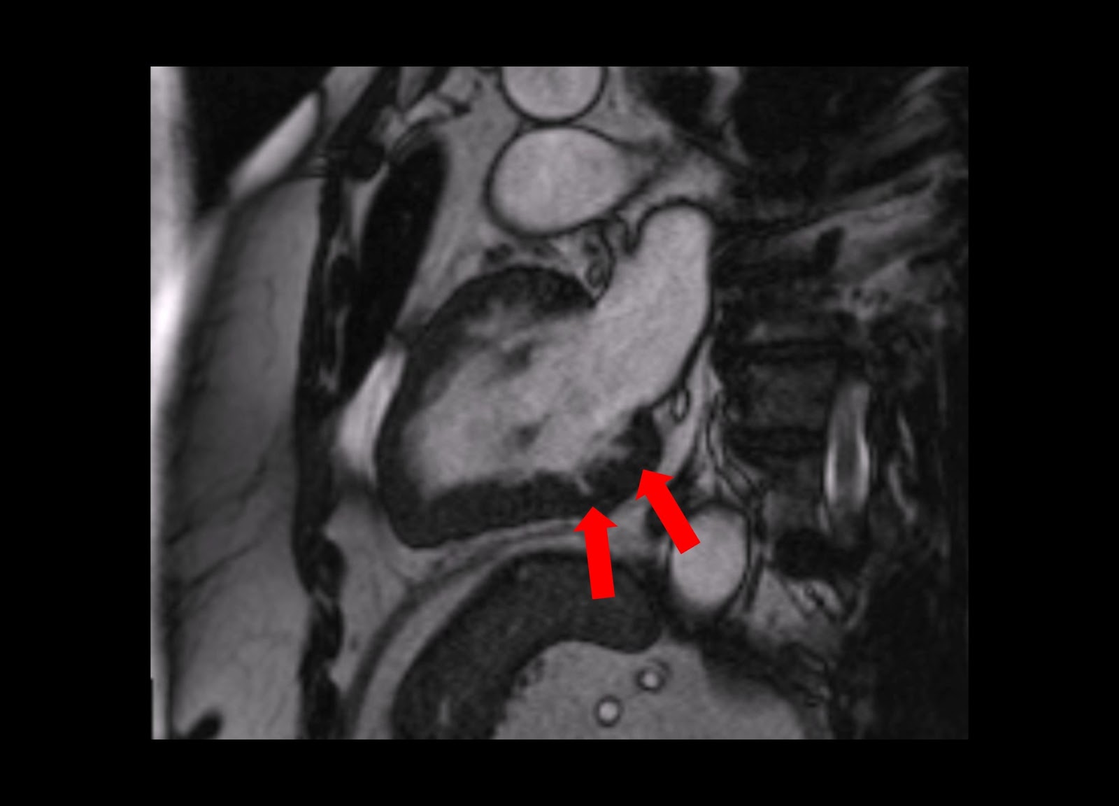 Andrew R. Houghton: Myocardial crypts in hypertrophic cardiomyopathy