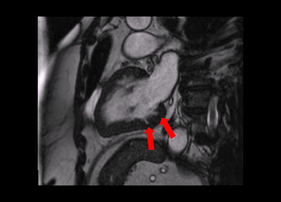 Andrew R. Houghton: Myocardial crypts in hypertrophic cardiomyopathy