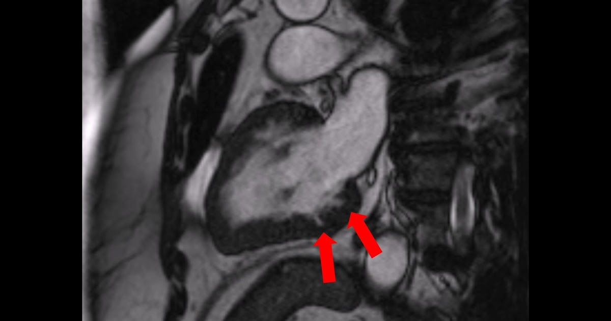 Andrew R. Houghton: Myocardial crypts in hypertrophic cardiomyopathy