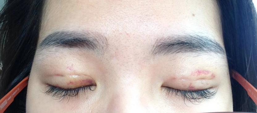 Karen Kho: 我的雙眼皮 (My Double Eyelid Stitching Experience)