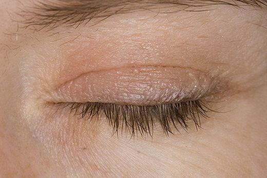 Dermatitis On Eyes