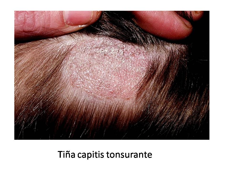 Micosis superficiales: Dermatofitosis (Tiñas)