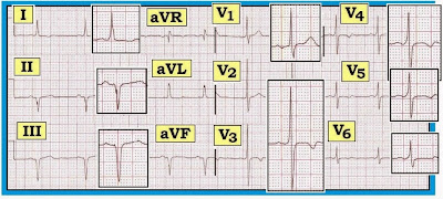 ECG Interpretation: ECG Interpretation Review #81 (Tall R Wave in Lead ...