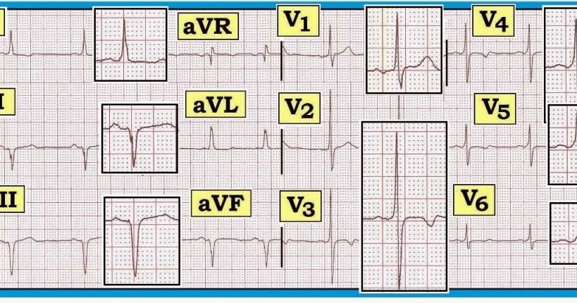 ECG Interpretation: ECG Interpretation Review #81 (Tall R Wave in Lead ...