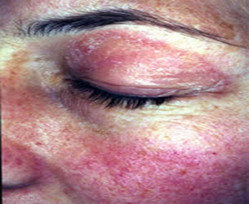 Histoblog: Dermatomiosite