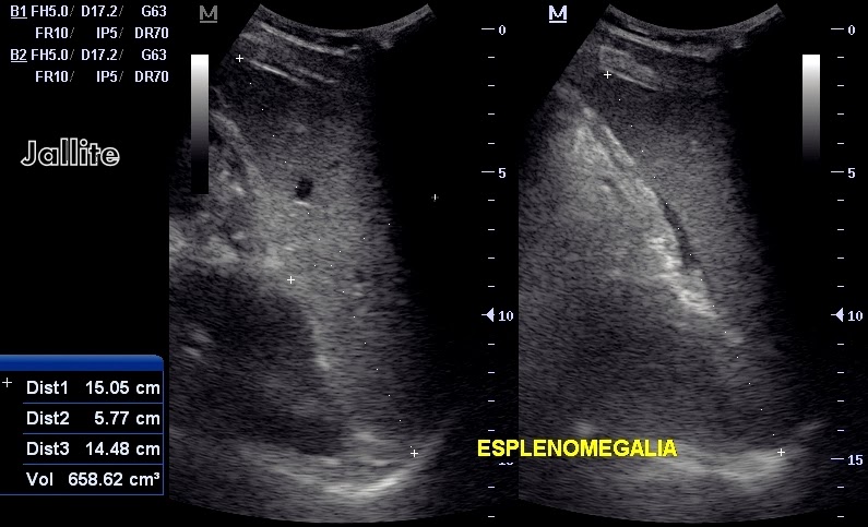 Apendicitis Perforada