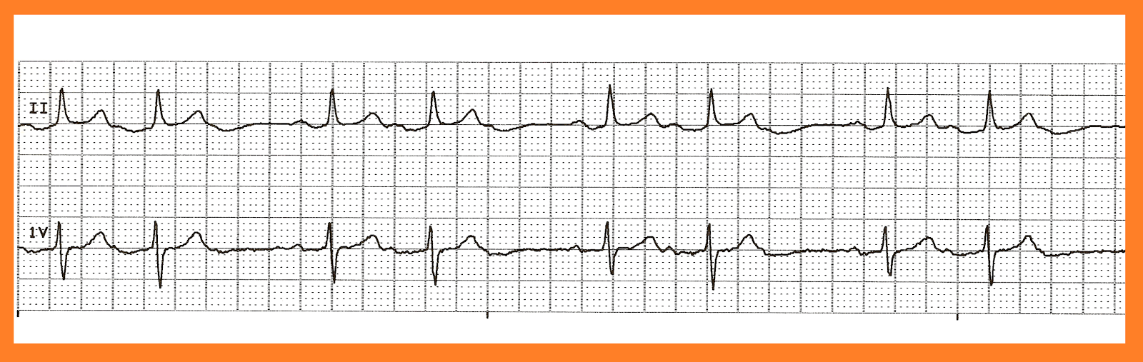 Basic EKG Rhythm Test 21 (Heart Block Challenge)