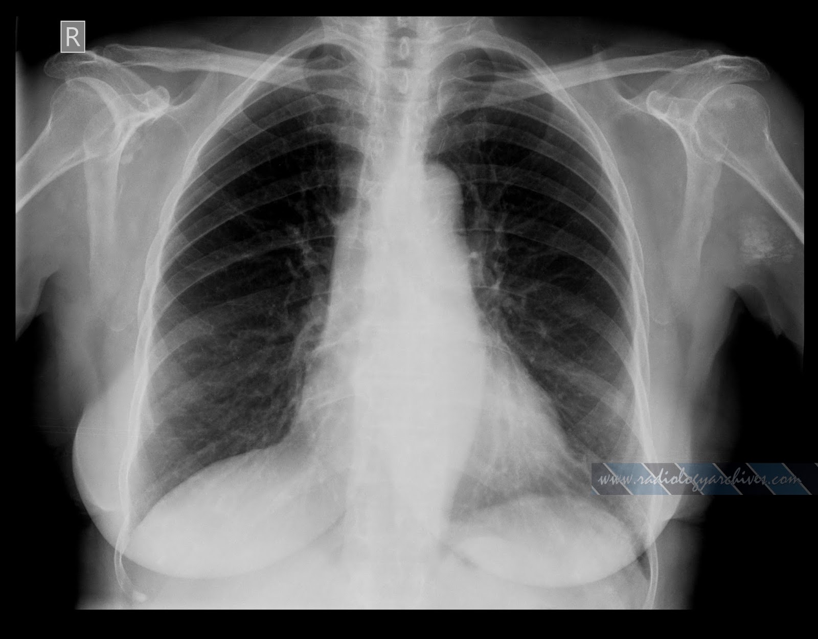 Radiology Archives: Εντοπισμένη (Περιγεγραμμένη) Εναπόθεση Ασβεστίου ...