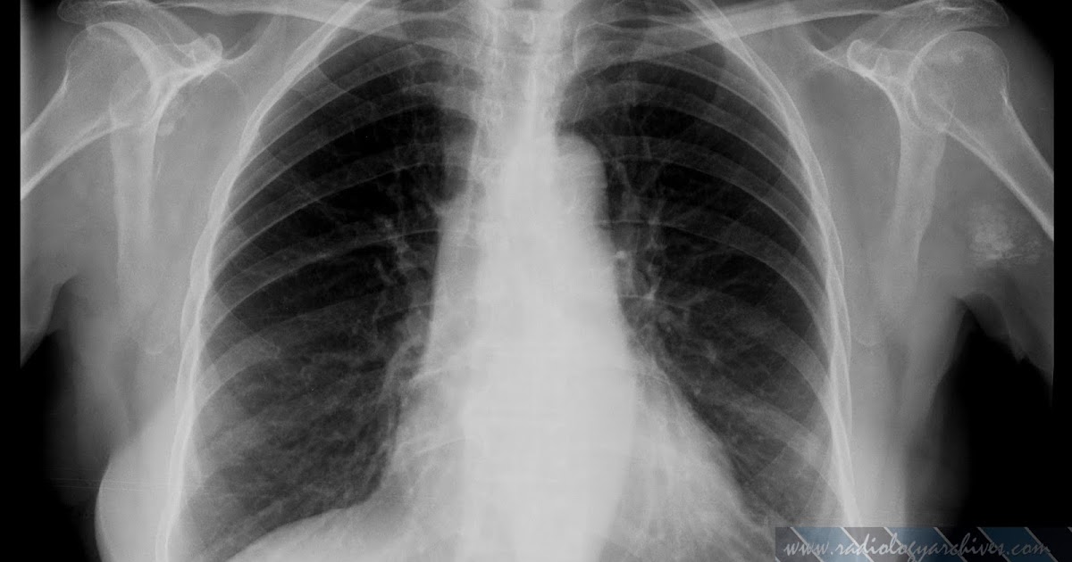 Radiology Archives: Εντοπισμένη (Περιγεγραμμένη) Εναπόθεση Ασβεστίου ...