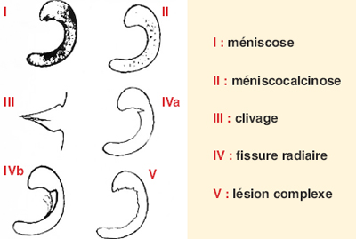 Un Jour En Chirurgie Orthopedique Et Traumatologique: Arthroscopie de ...