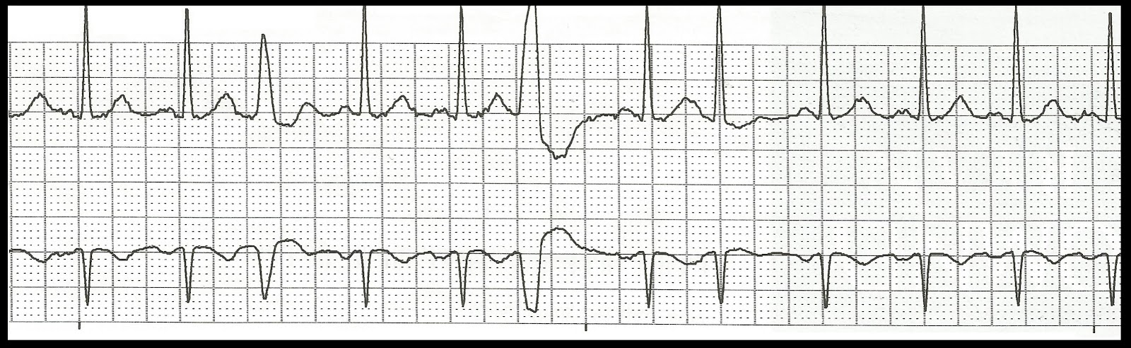 Practice EKG Rhythm Strips 162