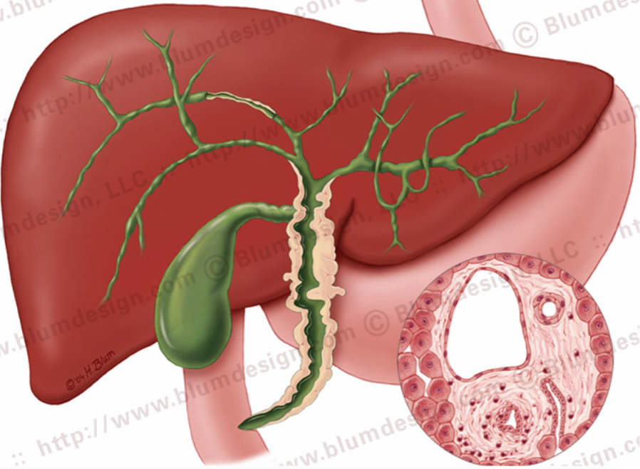 Primary biliary cirrhosis (PBC) | Belajar euy