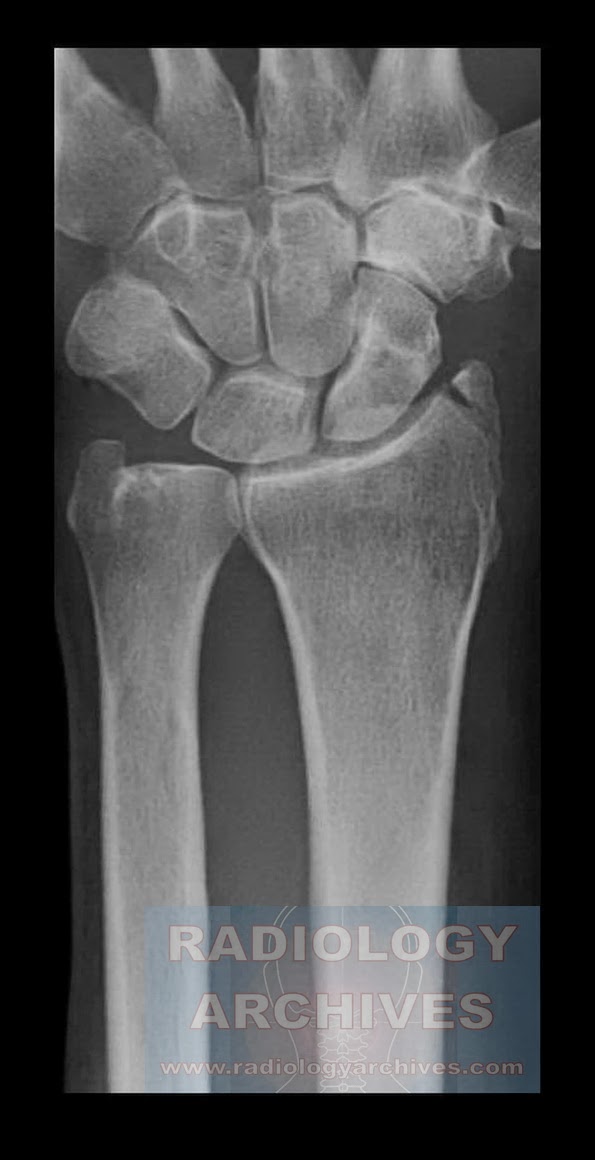 Radiology Archives: Κάταγμα Στυλοειδούς Απόφυσης Κερκίδας