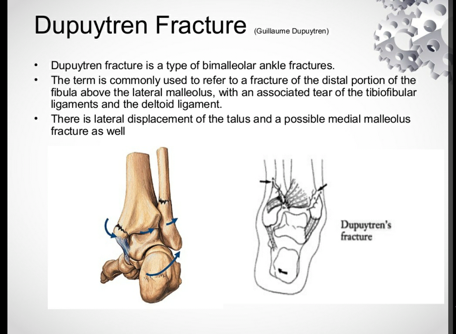 Duputren fracture