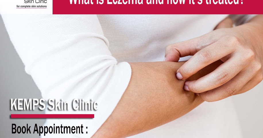 What is Eczema and how it’s treated? | KEMPS Skin Clinic