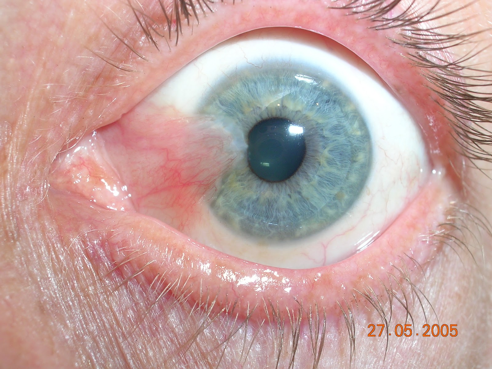 "Pterigión nuevo tratamiento" - MAXVISTA