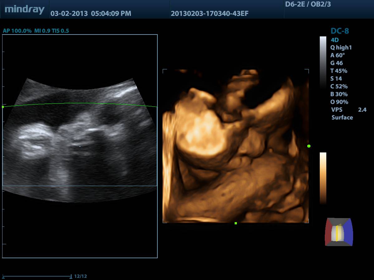 3D 4D Scan @ 32 weeks | With All My Heart & Soul..