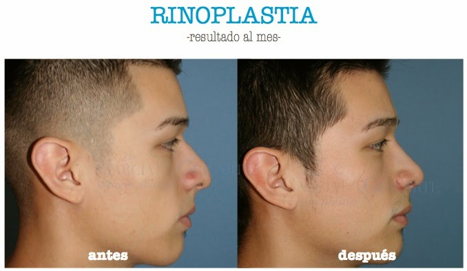 BLOG de CIRUGIA PLASTICA del Dr. FDEZ. G-GUILARTE: RINOPLASTIA ...