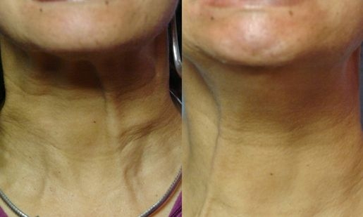Expansion Of The Neck With Sunken Throat Exercises And Face Yoga