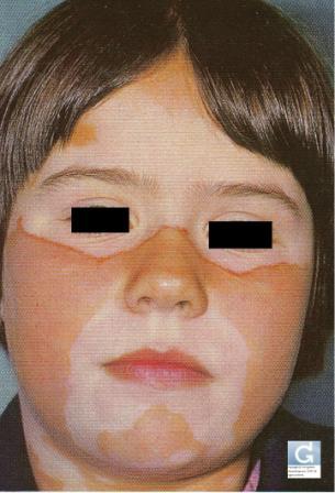 Vitiligo Cure 2011 Psoriasis Cure 2011 Cancer Cure 2011: Vitiligo