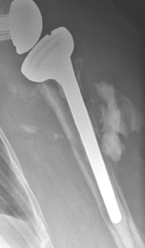 Shoulder Arthritis / Joint Replacement : Reverse total shoulder ...