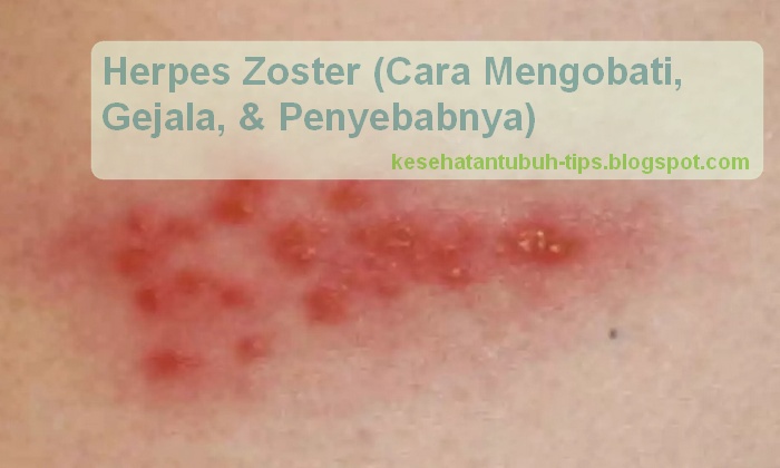 Koosehat - Mari Hidup Sehat: Herpes Zoster (Cara Mengobati, Gejala ...