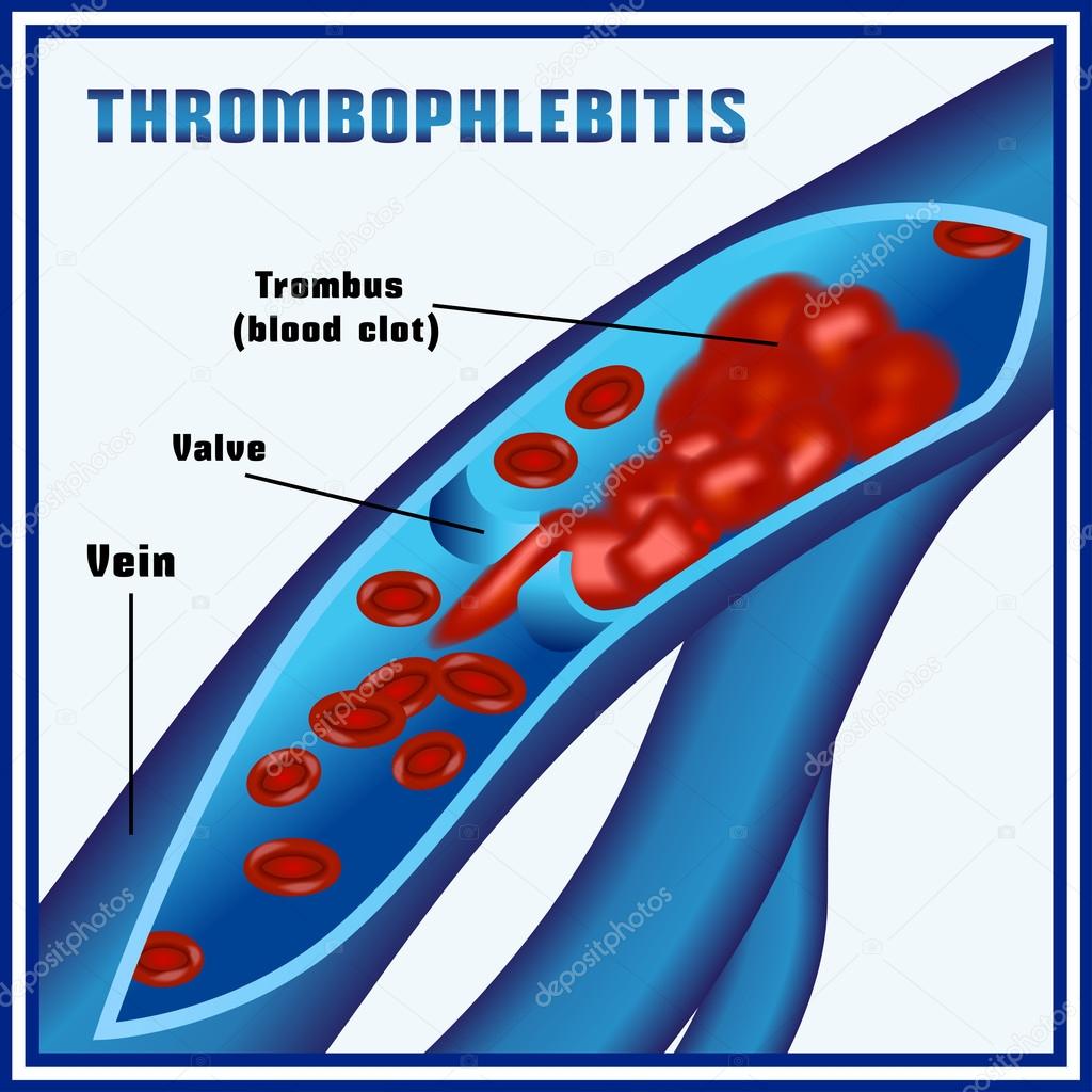 Reencontros: TROMBOFLEBITE
