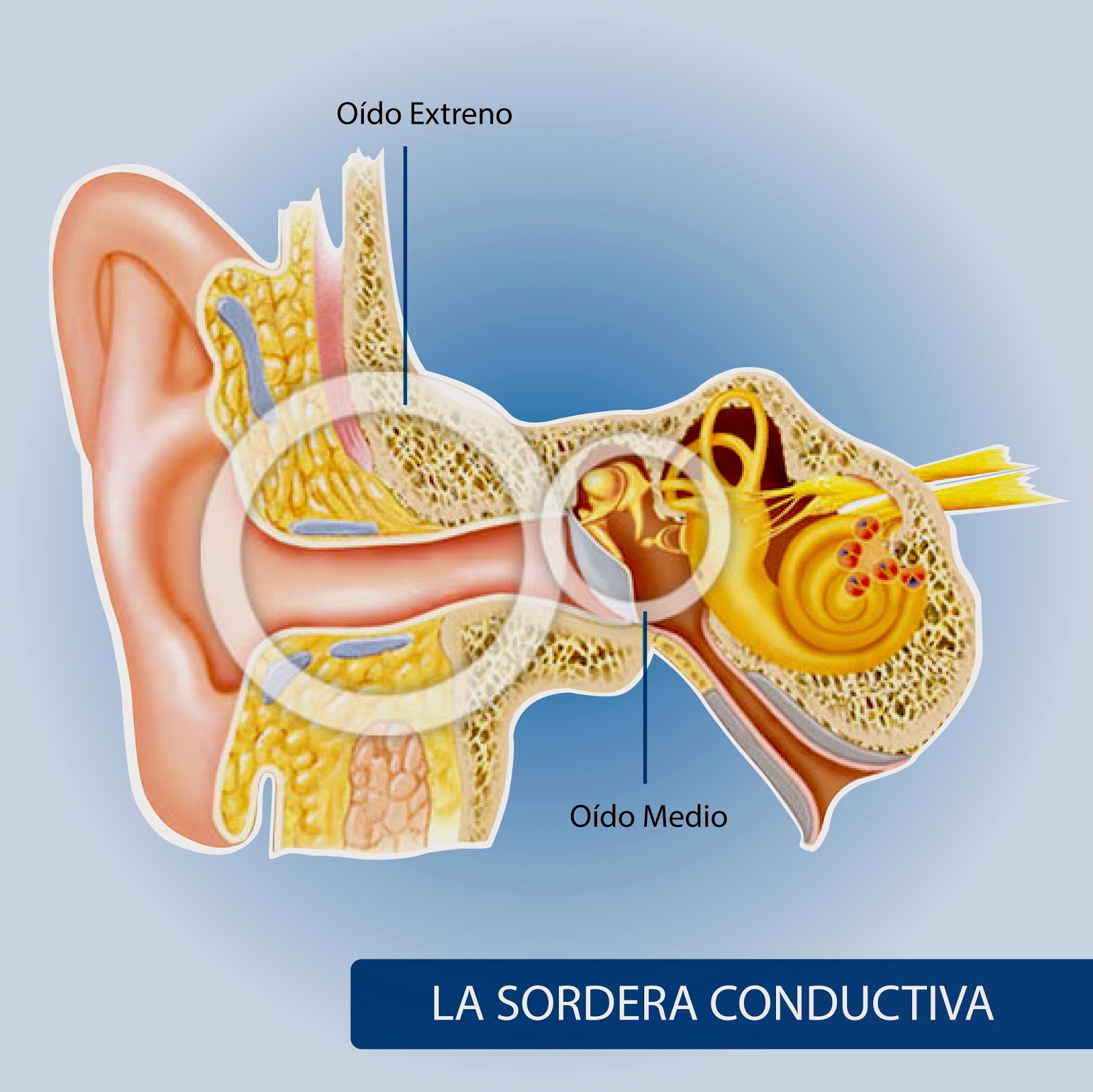 Audiomax: LA SORDERA CONDUCTIVA. AUDÍFONOS MEDICADOS