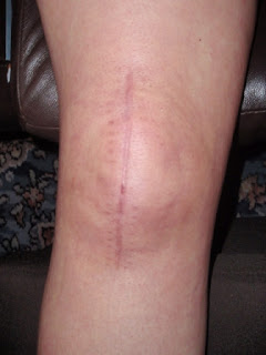 My Broken Knee Story