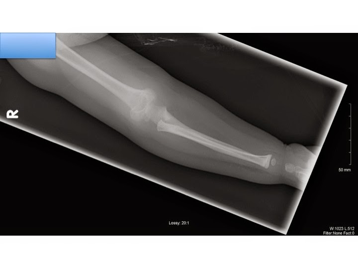 Shoulder and Elbow Surgery: Pediatric supracondylar humerus fracture.