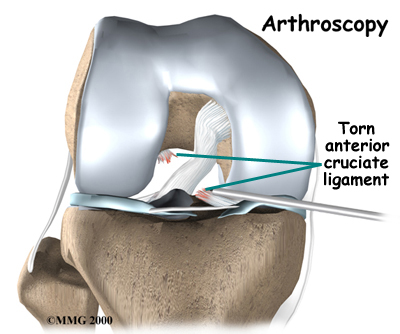Famous World: Famous Acl Injuries