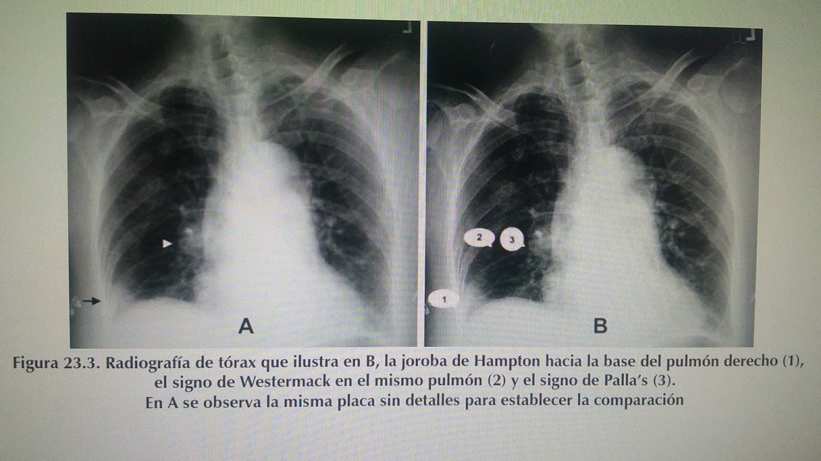 Tromboembolismo Pulmonar