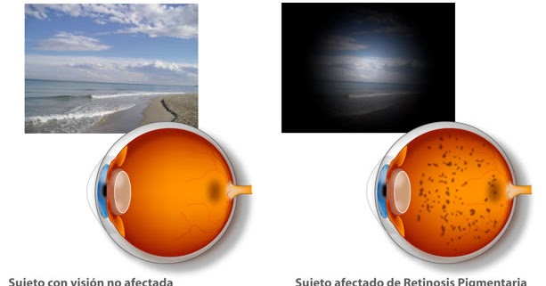 FISIOLOGÍA DE LA RETINA: Manifestaciones clínicas de RP
