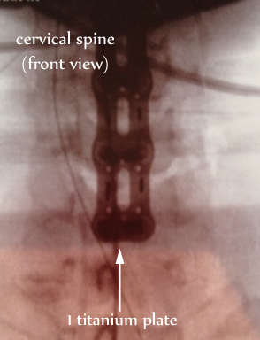One titanium plate and eight screws later... | abandoned to Christ.
