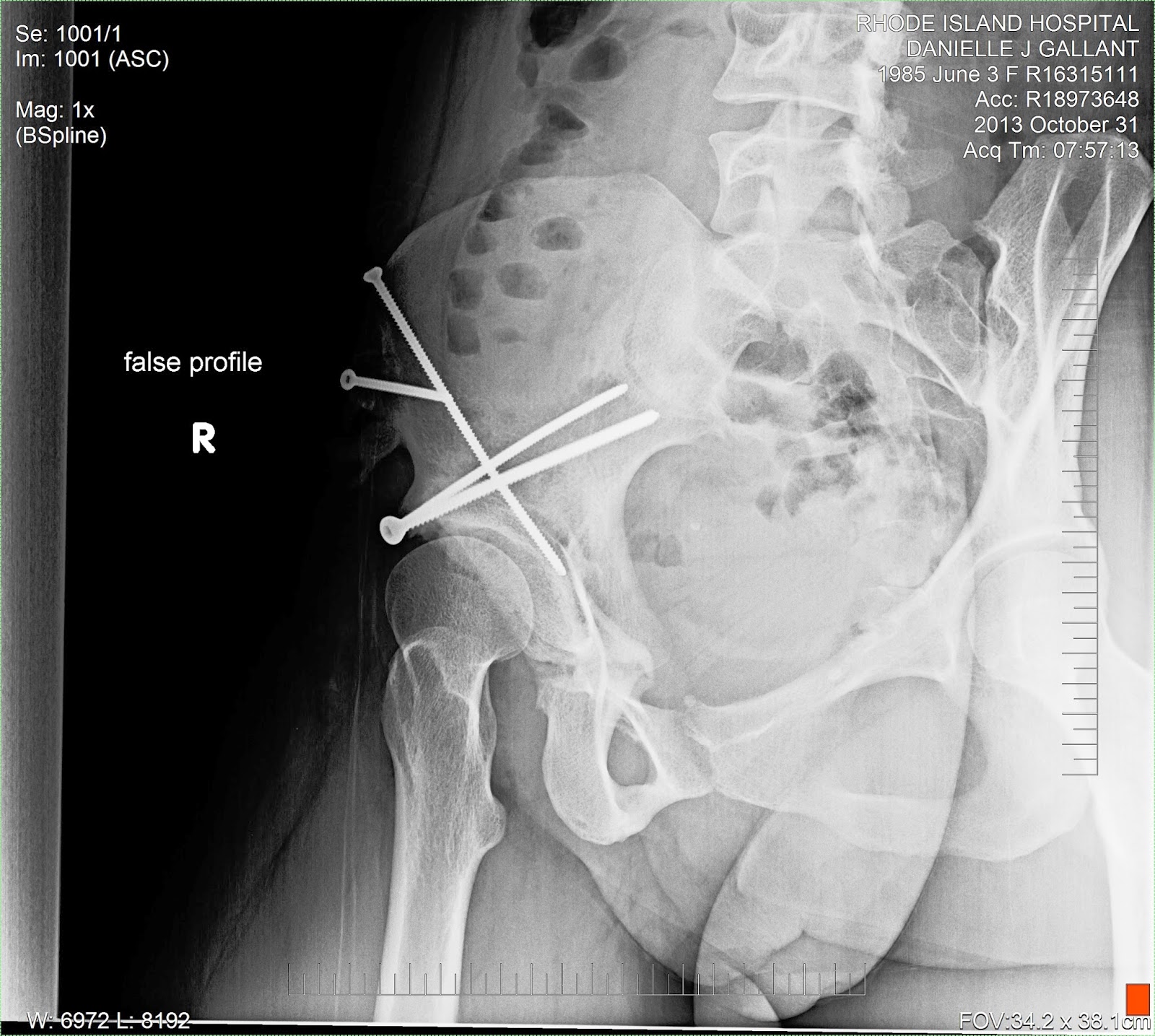 Hip-y Chick - Living a PAO'd Life: A Hip Journey Through Photographs