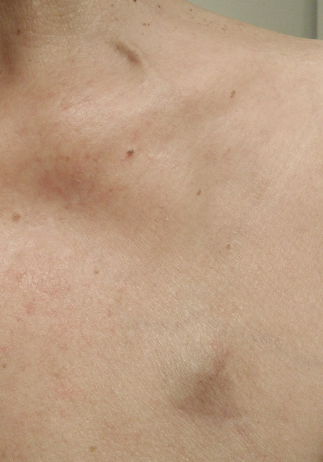 Rocquie's Lymphoma: Port-a-Cath Placement