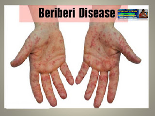 SONU ACADEMY: DEFICIENCY DISEASES- TEXT