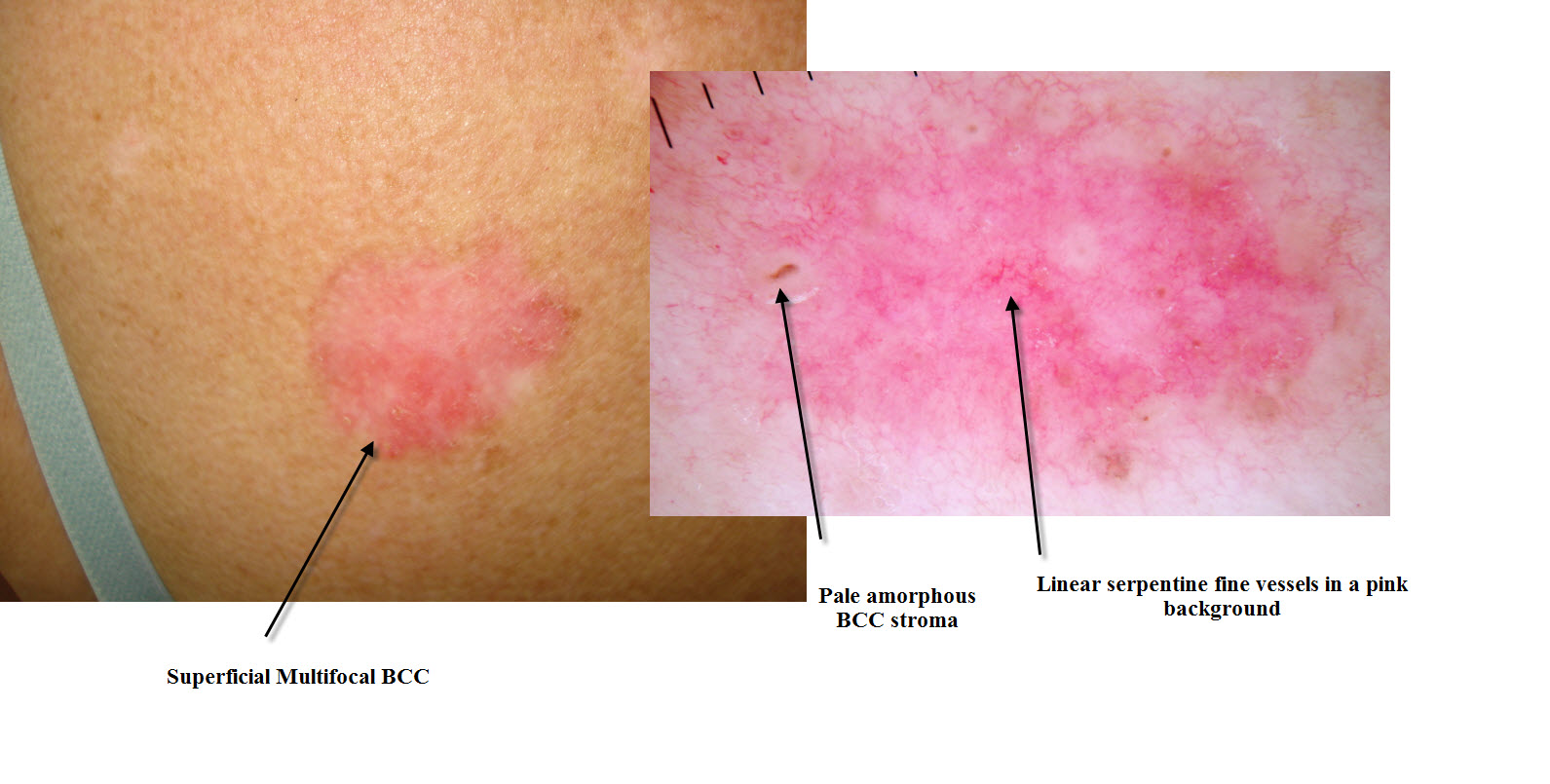 Dermpath Made Simple - Neoplastic: Basal Cell Carcinoma