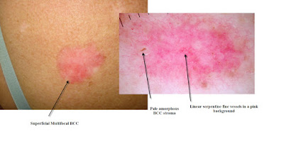Dermpath Made Simple - Neoplastic: Basal Cell Carcinoma