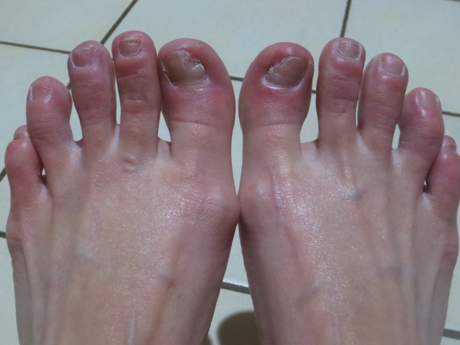 Live With ME/CFS: Heat Desensitization - Erythromelalgia in Remission!