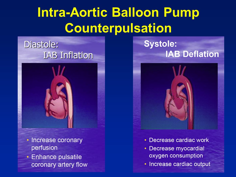 CVT Mohd Farid: Cardiac Support Devices Management Of Patient On IABP ...