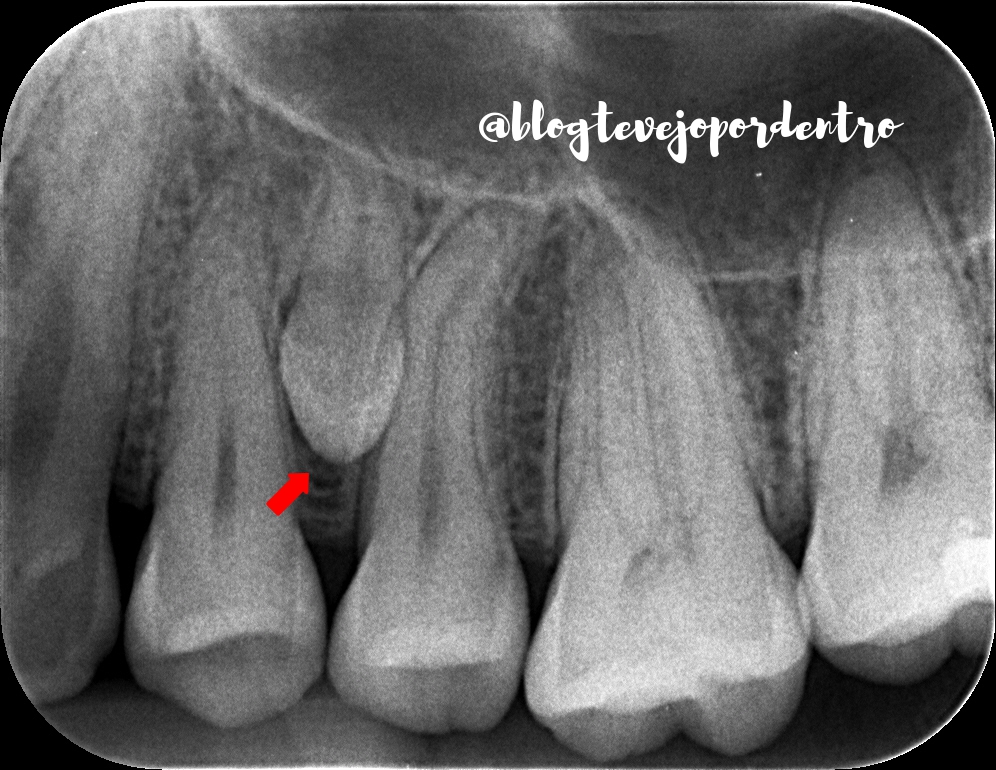 "Te vejo por dentro": Supranumerário