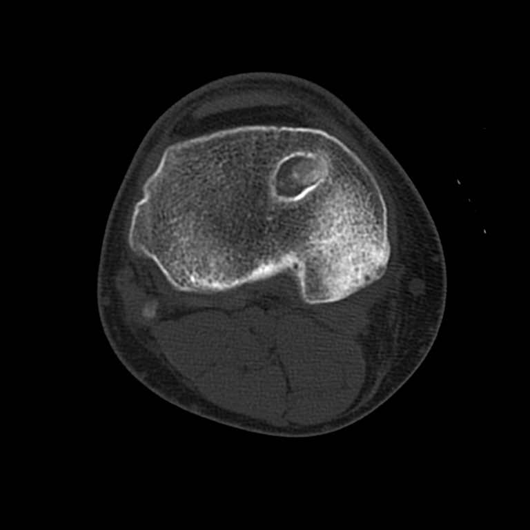 CT Knee - Radiology Imaging