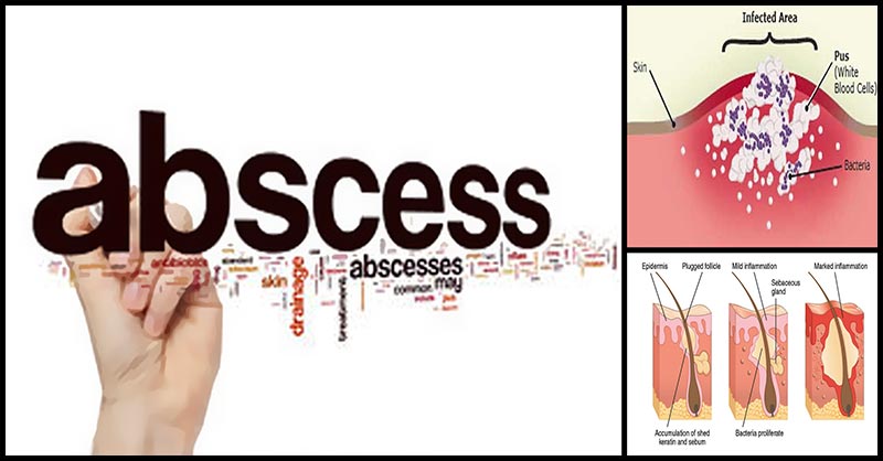 Boils and Abscesses: All-Natural Home Remedies | Dr Farrah MD