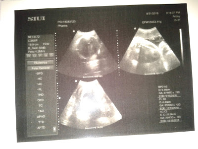 Contoh Hasil USG Kandungan Usia 8 Bulan