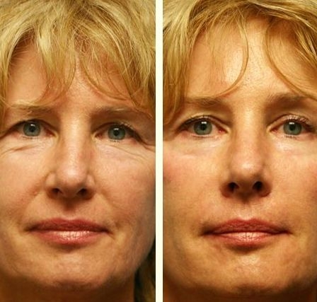 Natural Chinese Facelift: Age-Shedding Using Facial Yoga : Facelift ...