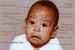 Escola Antenada: Microcefalia