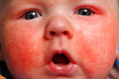 Psoriasis In Children: Treatment, Symptoms And Causes | Celebrities Funda