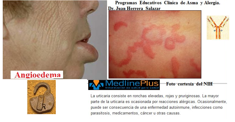 Clínica de Asma y Alergia, Managua,Nicaragua: Urticaria y Angioedema