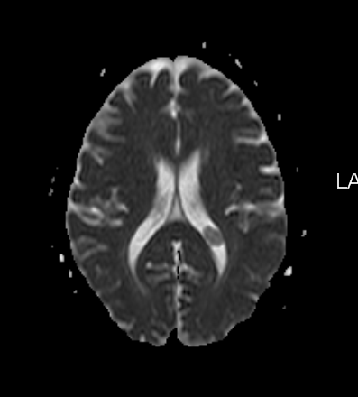 Choroid Plexus Xantogranulomata-MRI - Sumer's Radiology Blog